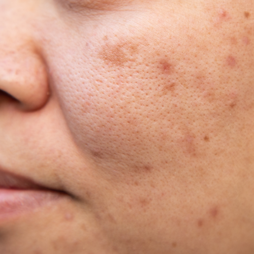 Acne Scarring Treatment London | Dr Emma Wedgeworth